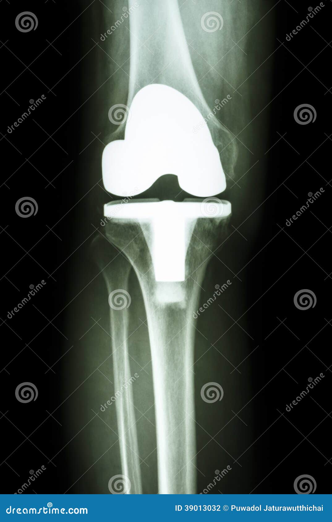 Joint Prosthesis stock photo. Image of hospital, person - 39013032