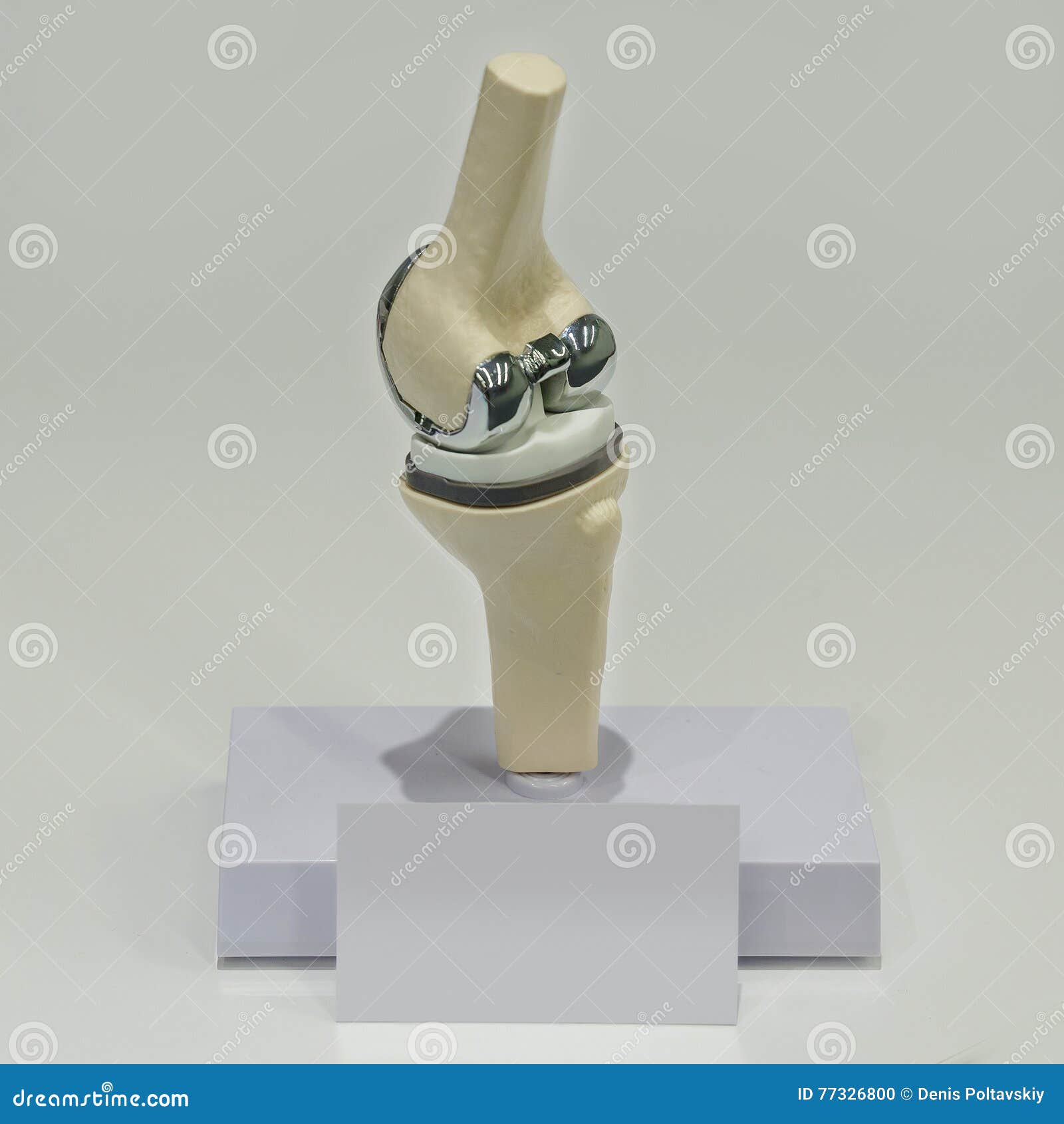 Joint prosthesis stock photo. Image of meniscus, fracture - 77326800
