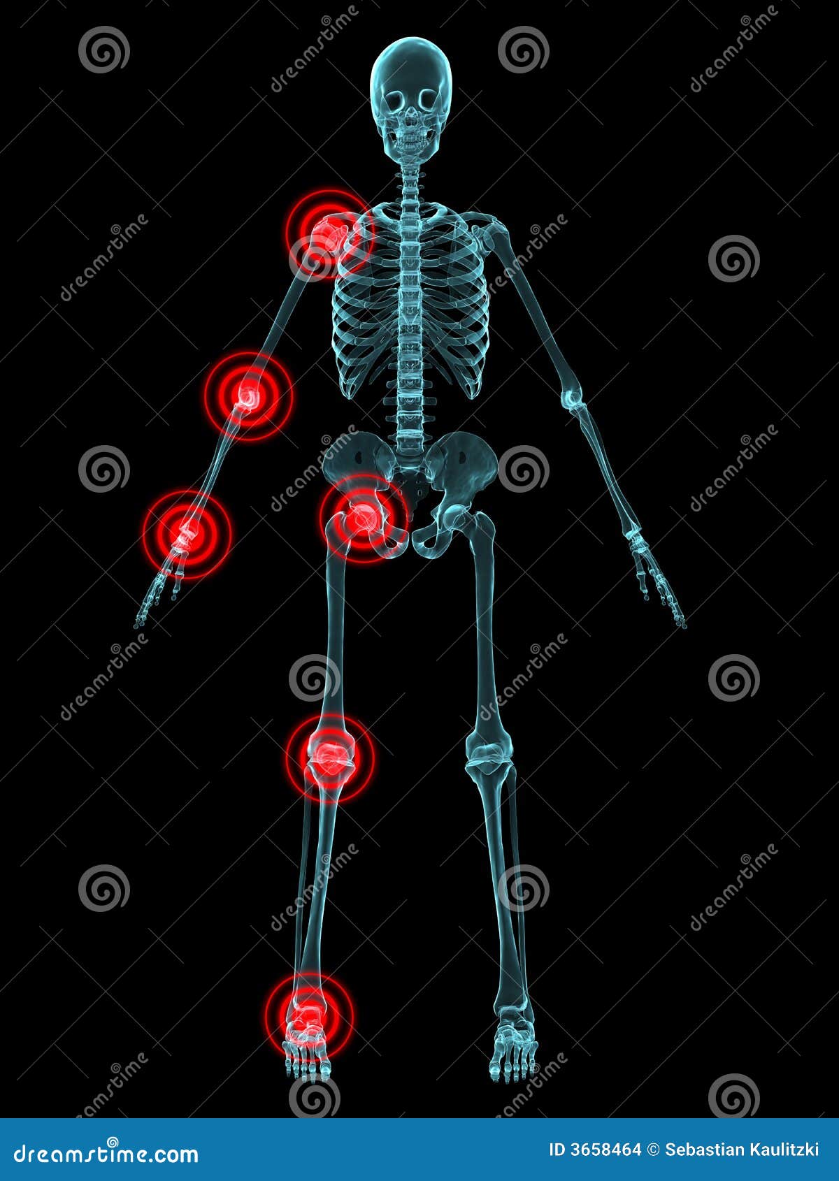 Joints inflammation stock illustration. Illustration of skeleton - 3658464