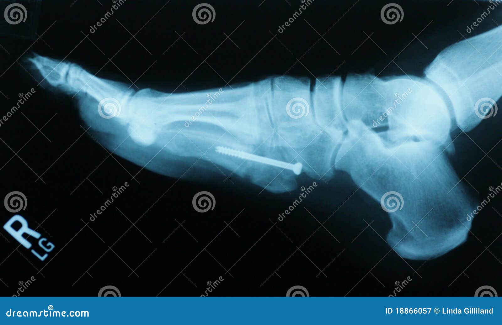Jones Fracture Repair stock image. Image of radiograph - 18866057