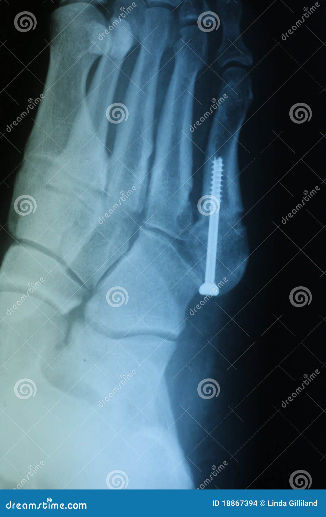 Jones Fracture Repair 2 stock photo. Image of surgical - 18867394