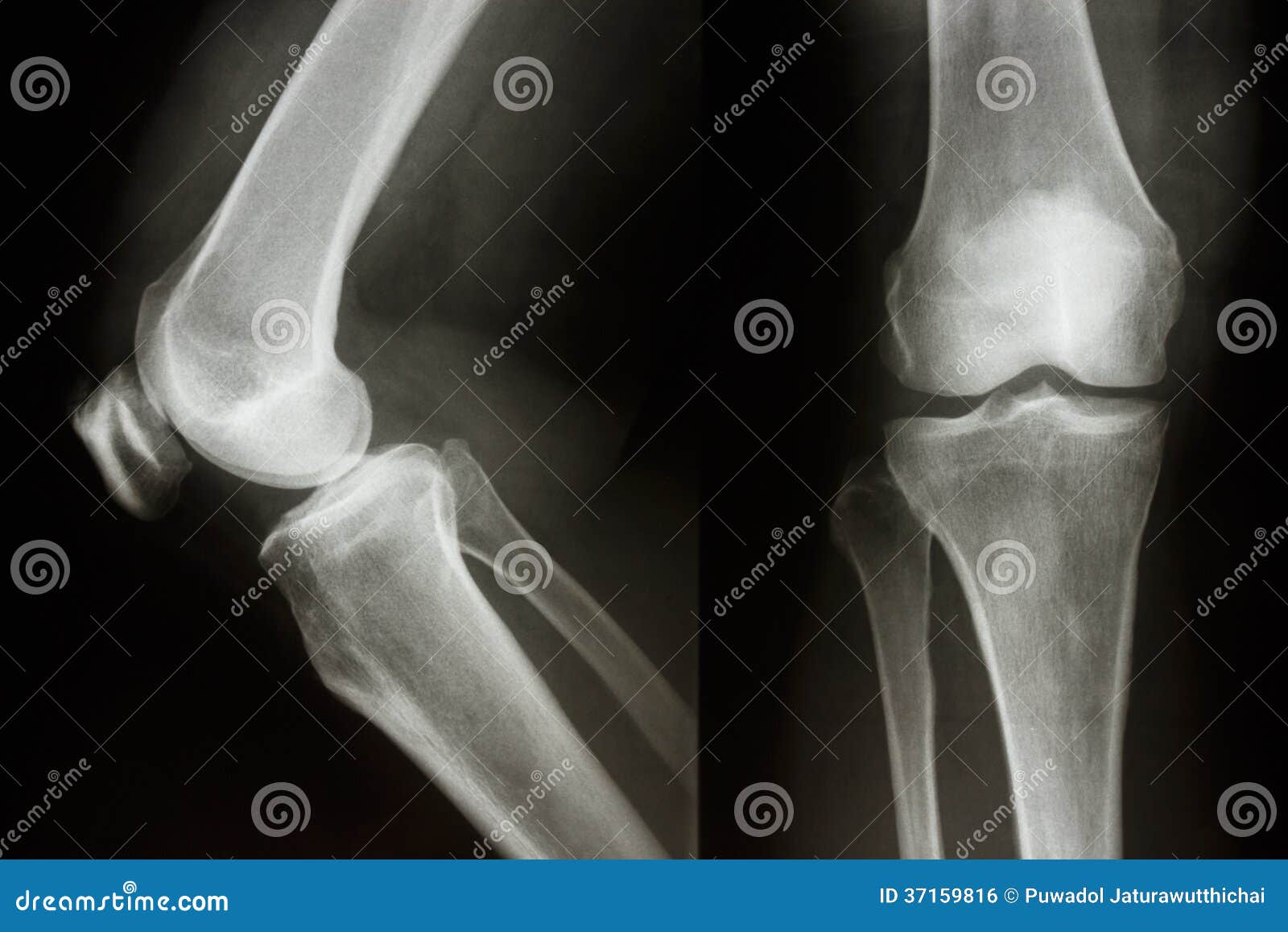 Junta de rodilla normal foto de archivo. Imagen de tibia - 37159816