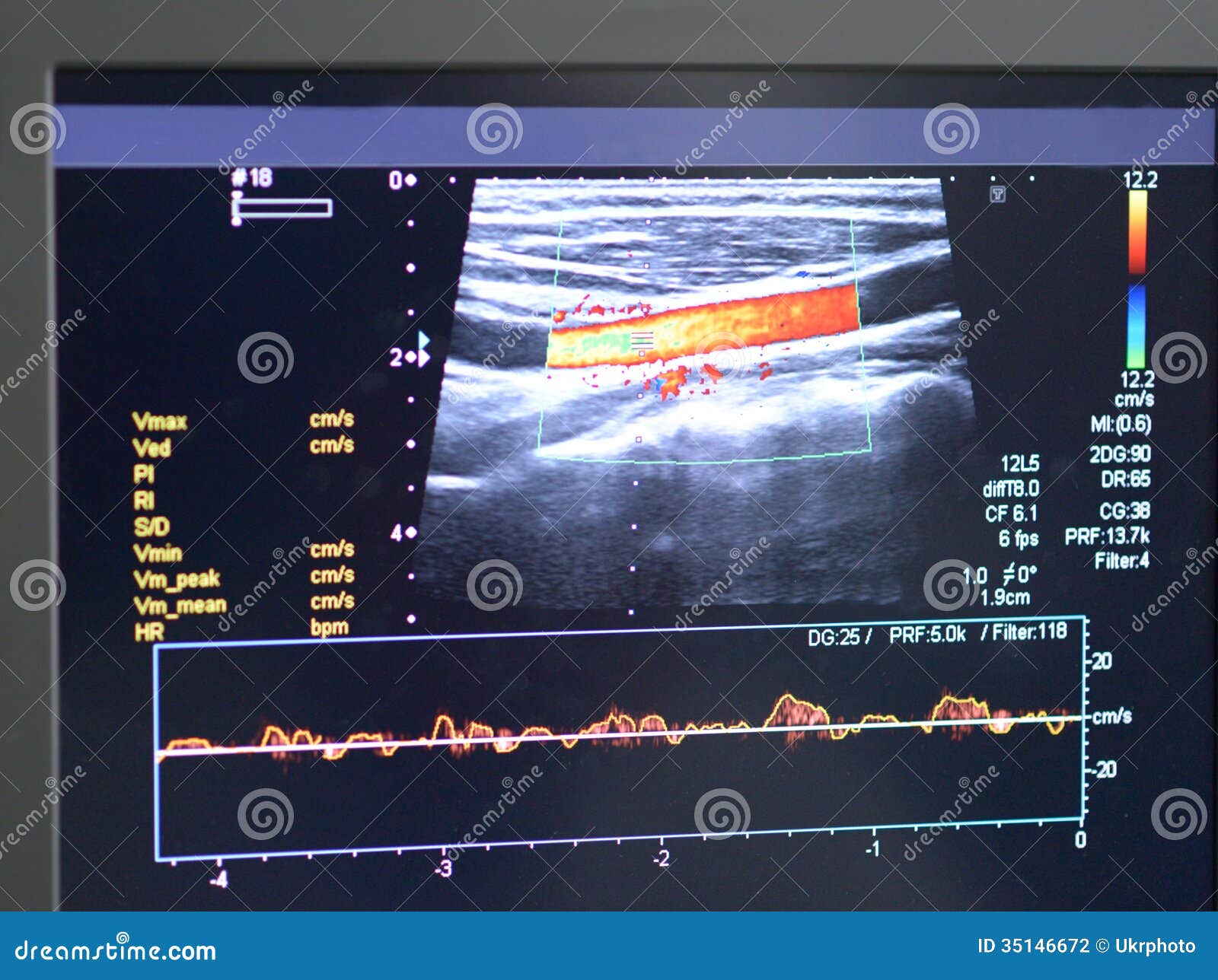 Kärl- ultraljud arkivfoto. Bild av horisontal, dopplare - 35146672