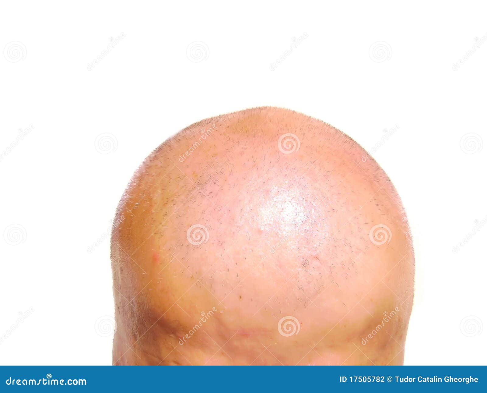 Kahler Kopf stockfoto. Bild von kopfhaut, medizinisch - 17505782