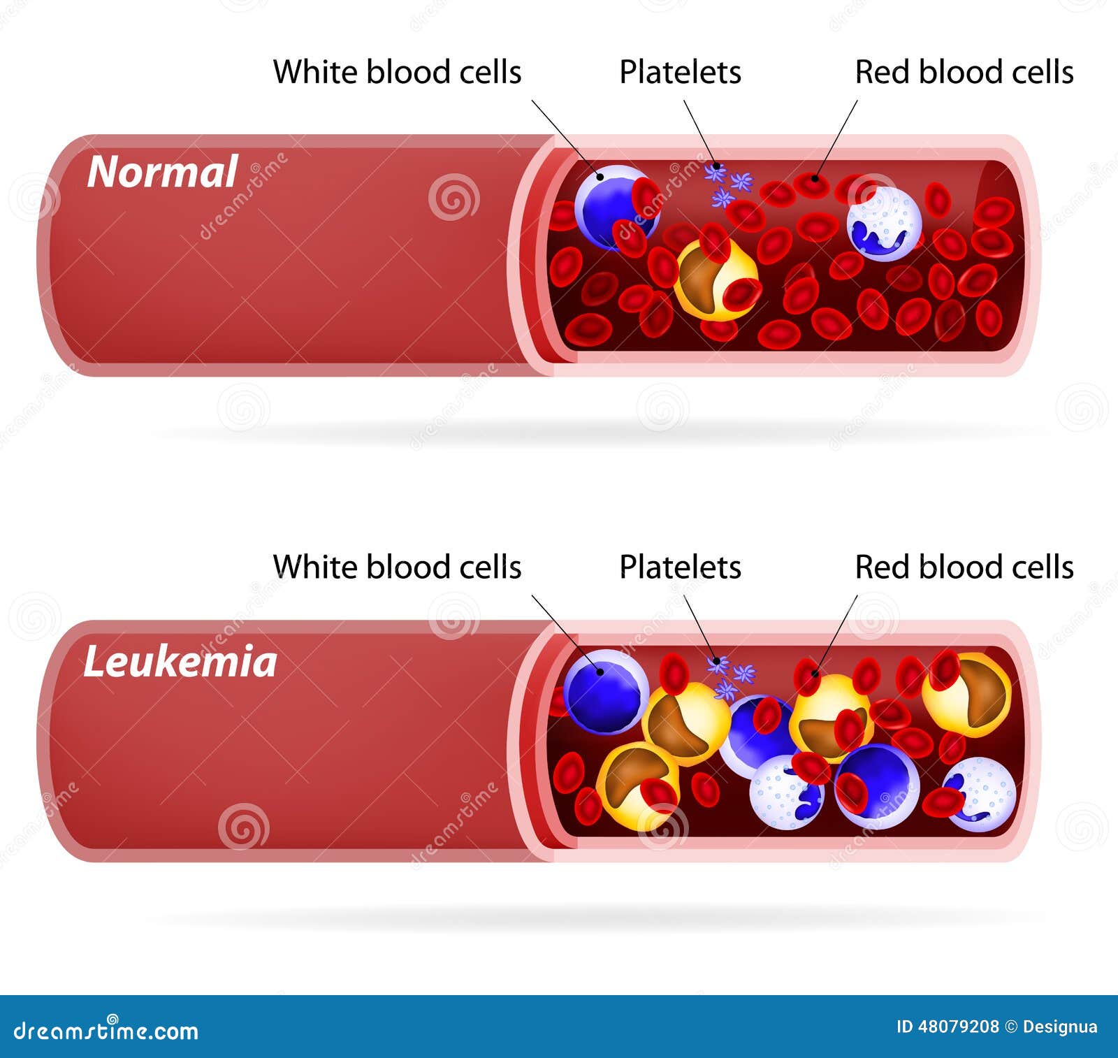 Kanker Leukemie of Leukemie Vector Illustratie - Illustration of ...