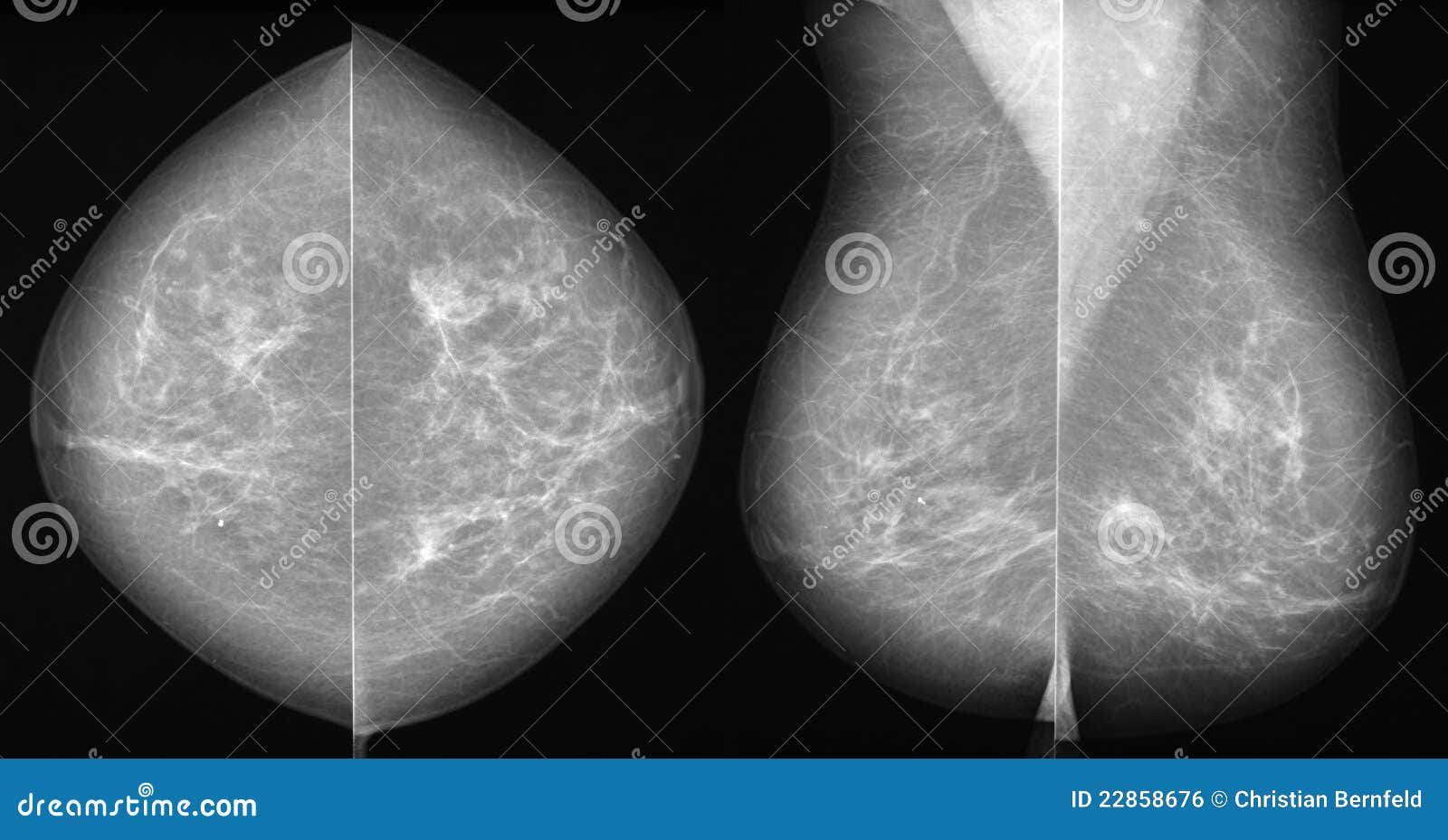 Kankermammography Van De Borst in 2 Projecties Stock Foto - Image of ...