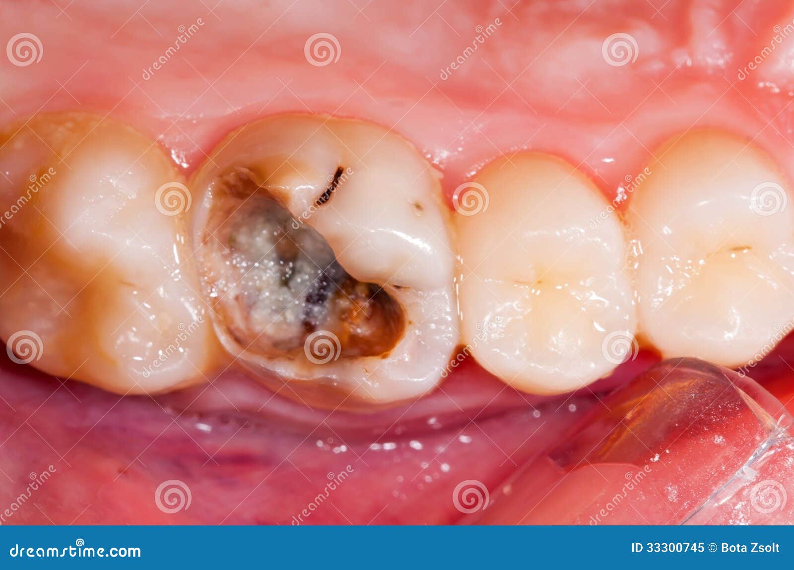 Karies stockbild. Bild von mündlich, bakteriell, gesundheit - 33300745