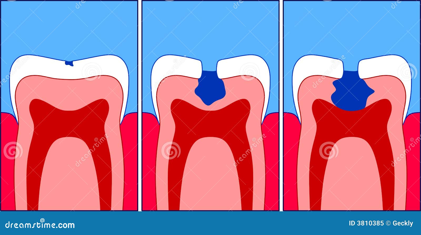 Karies vektor abbildung. Illustration von zeichen, einbuchtung - 3810385