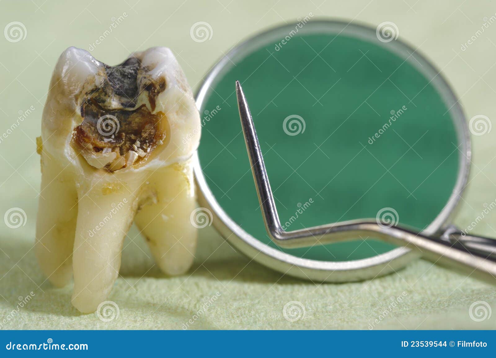 Karies auf Zahn stockfoto. Bild von spiegel, zahnheilkunde - 23539544