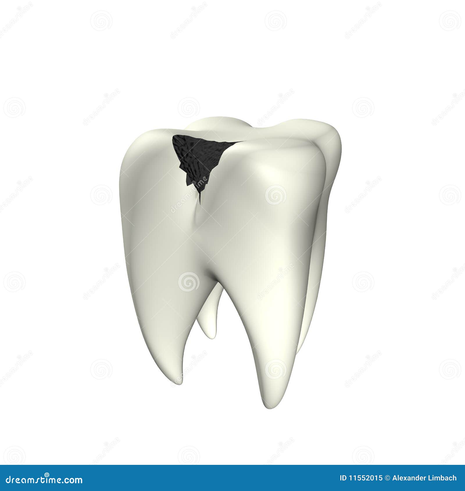 Karies-Zahn 3D stock abbildung. Illustration von zerfall - 11552015