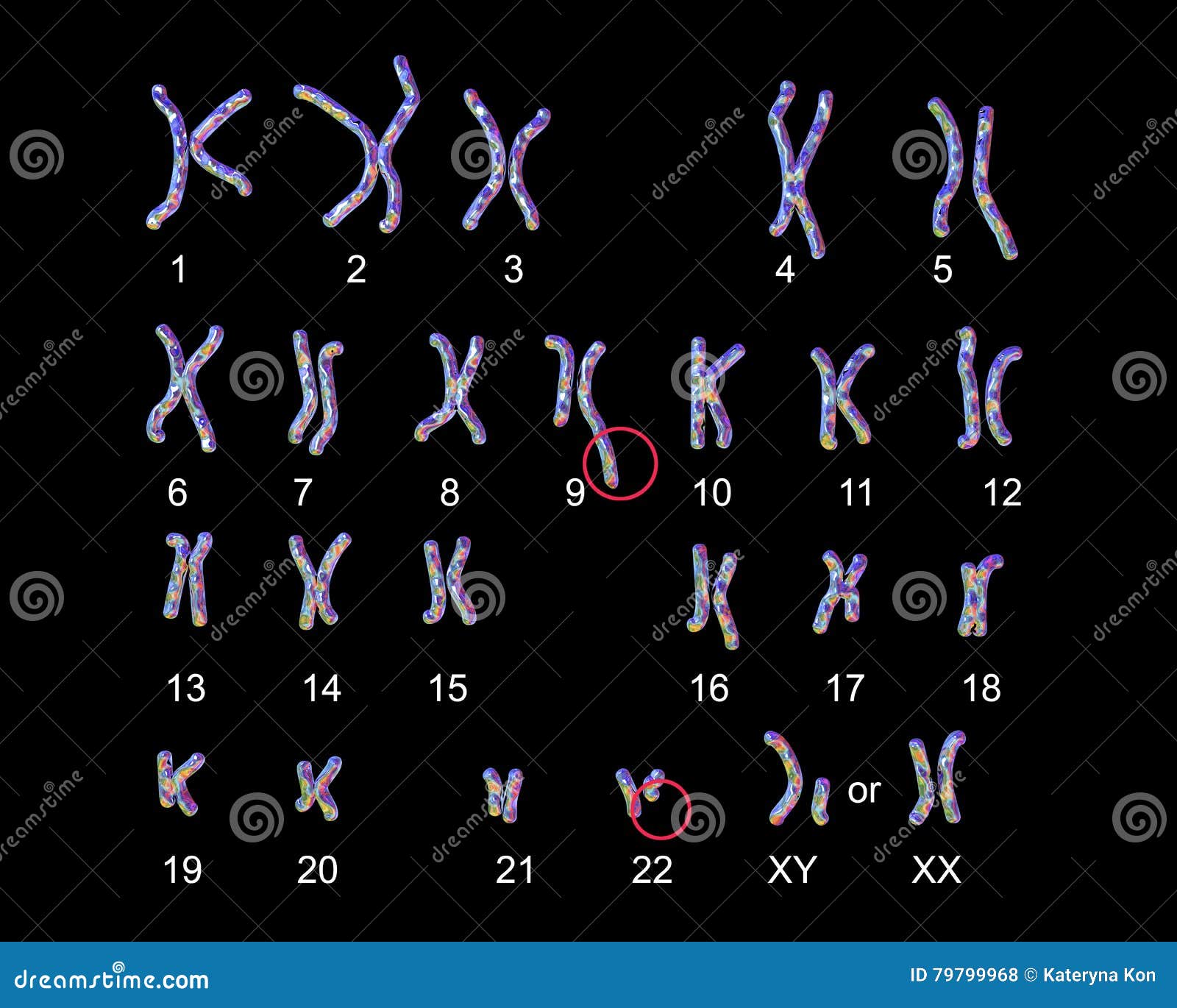 Karyotype Do Cromossoma De Philadelphfia Ilustração Stock - Ilustração ...