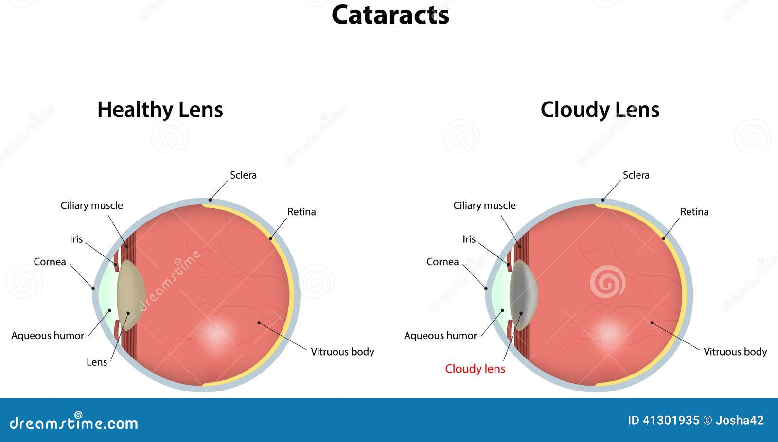 Katarakte vektor abbildung. Illustration von blende, anblick - 41301935