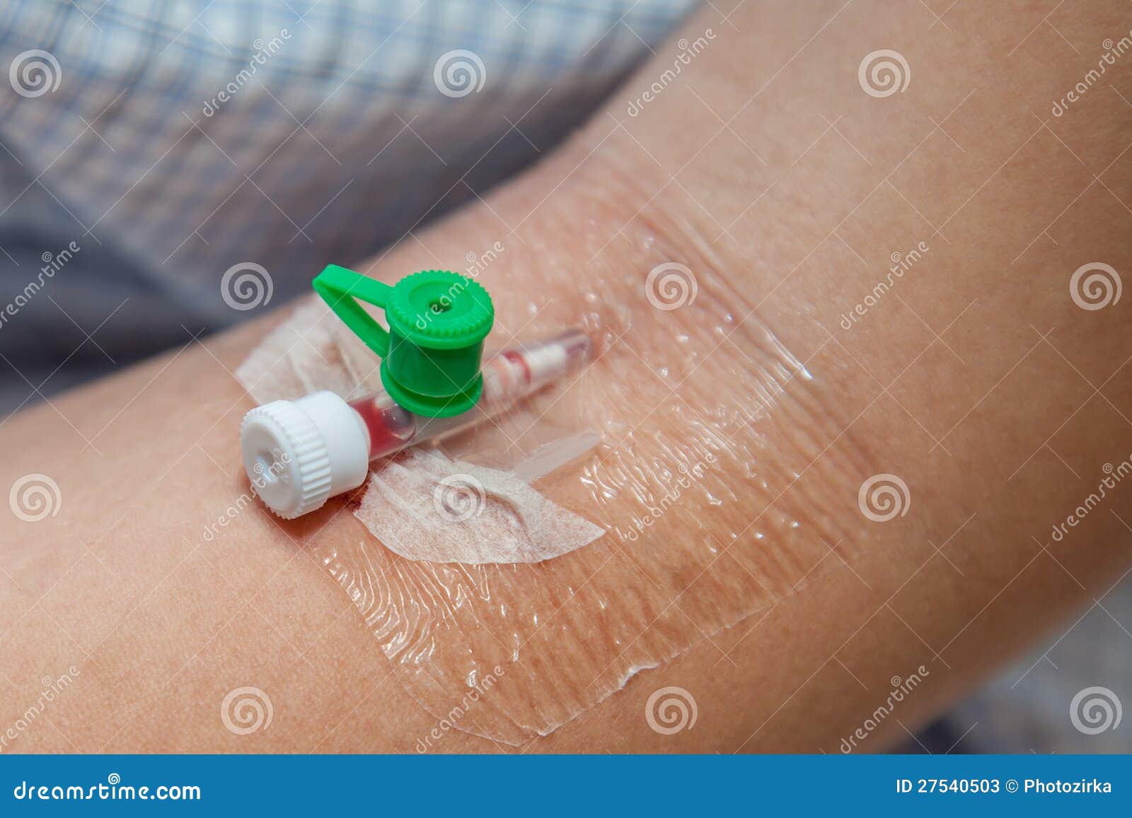 Katheter in die Ader stockbild. Bild von krankheit, umklammert - 27540503