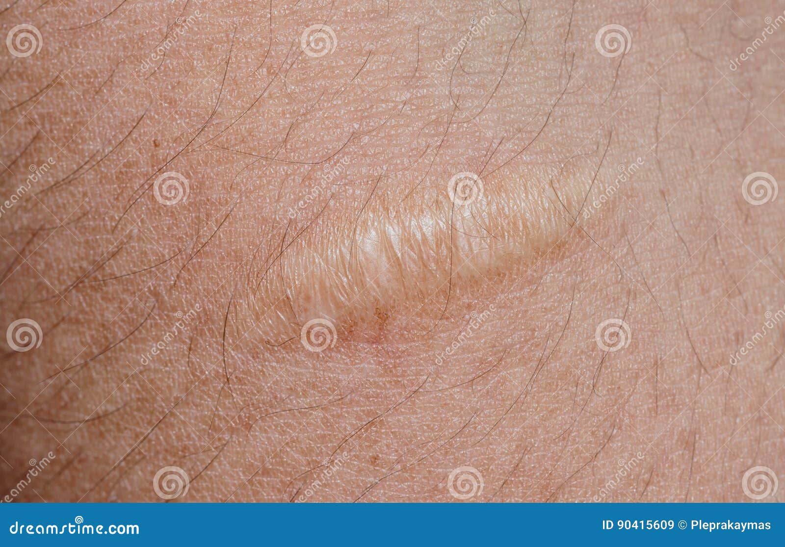 Keloid Scar Stock Images Royaltyfree Images Vectors Keloid Scar Stock Images Royaltyfree Images Vectors