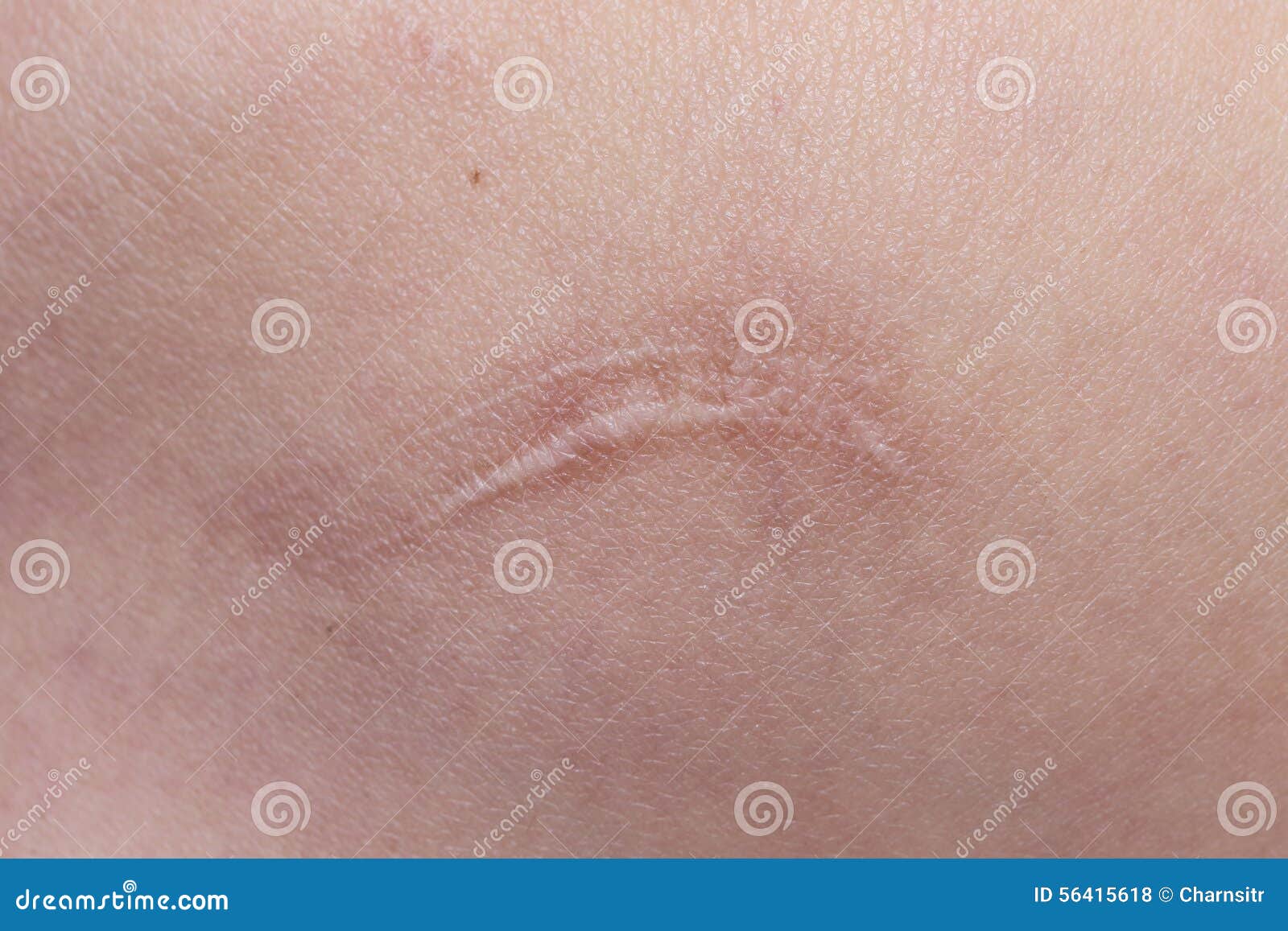Keloid scar on skin stock photo. Image of painful, scratch - 56415618