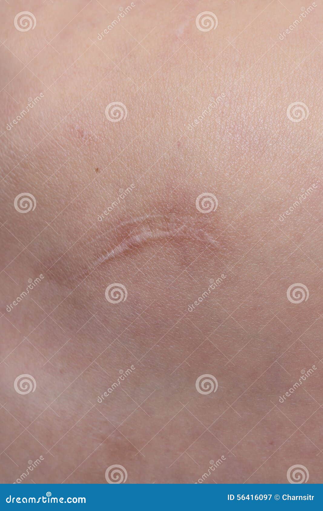 Keloid Scar Hypertrophic Scar On Man Hand Skin After Accident. Keloidal ...
