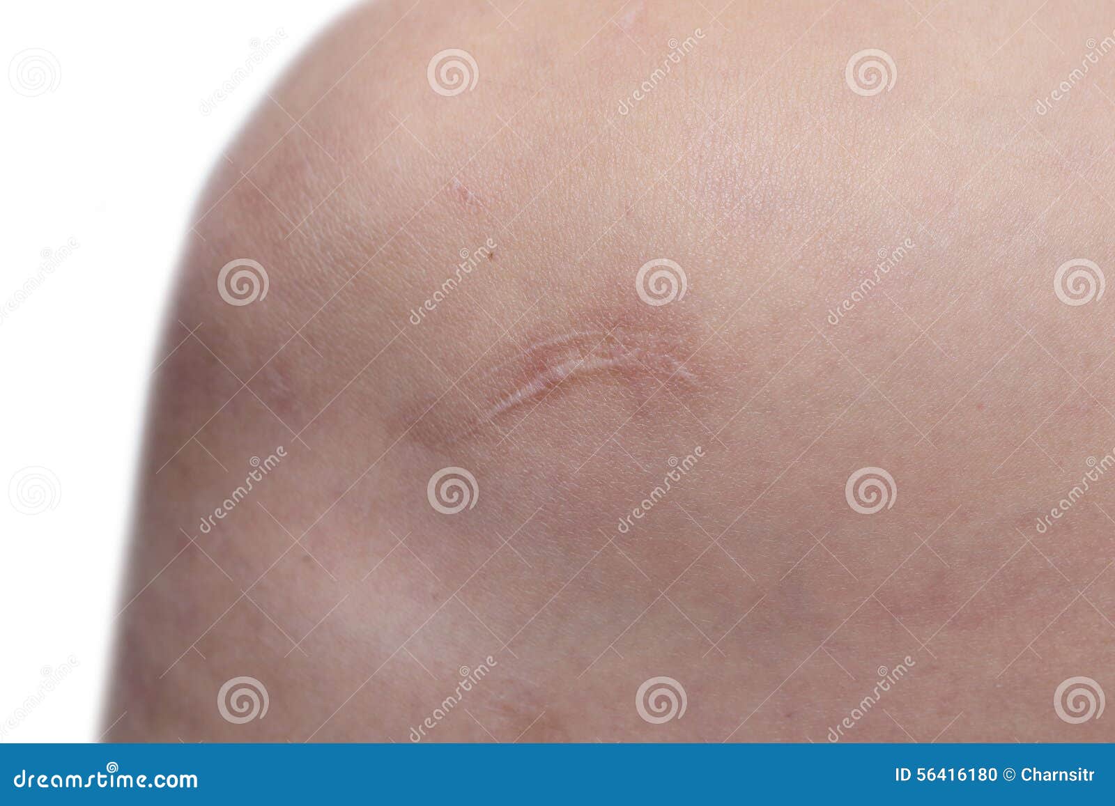 Keloid Scar On Skin Royalty-Free Stock Photography | CartoonDealer.com ...