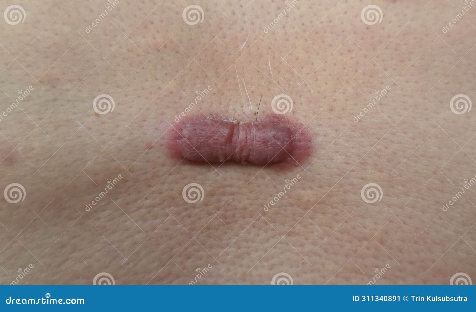 Keloid Scars are Large, Raised Scars Stock Image - Image of painful ...