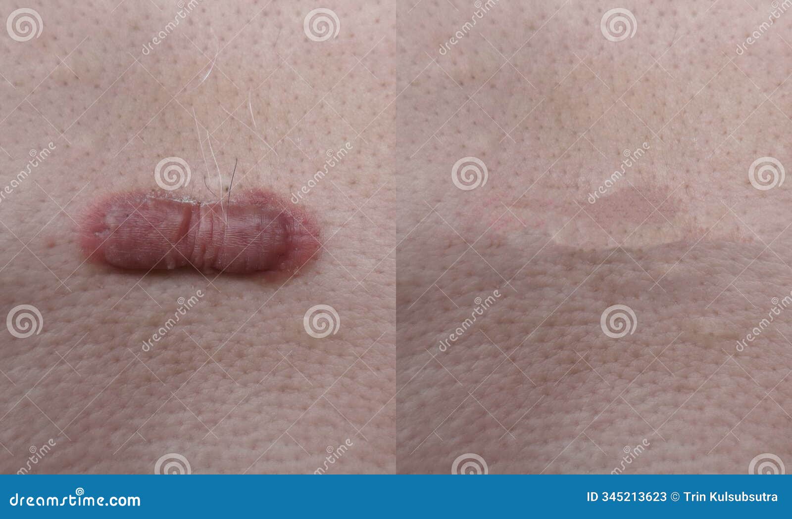 Raised Scar. Scar After Appendectomy. Cyanotic Keloid Scar Caused By ...