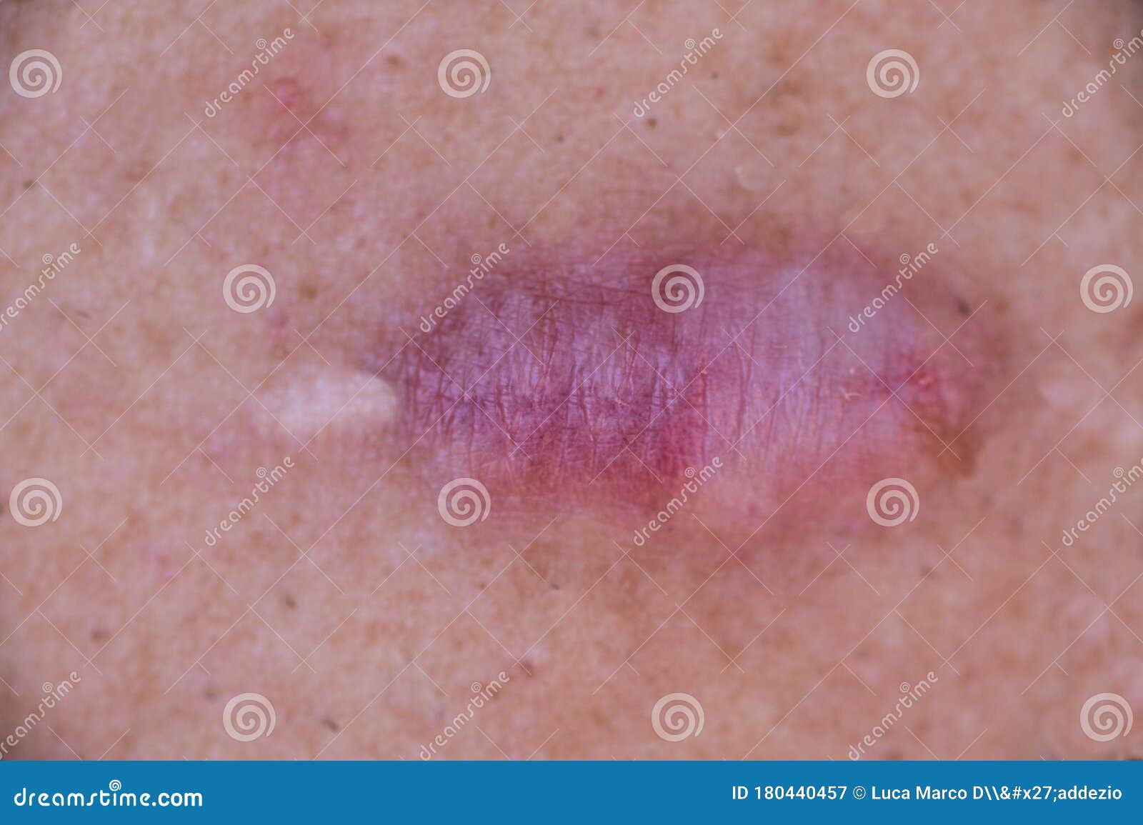 Keloid stock image. Image of genetic, close, hypertrophic - 180440457