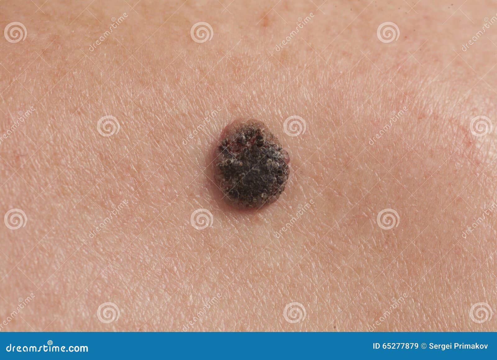 Keratinizing Squamous Cell Carcinoma Of The Skin Stock Photo ...