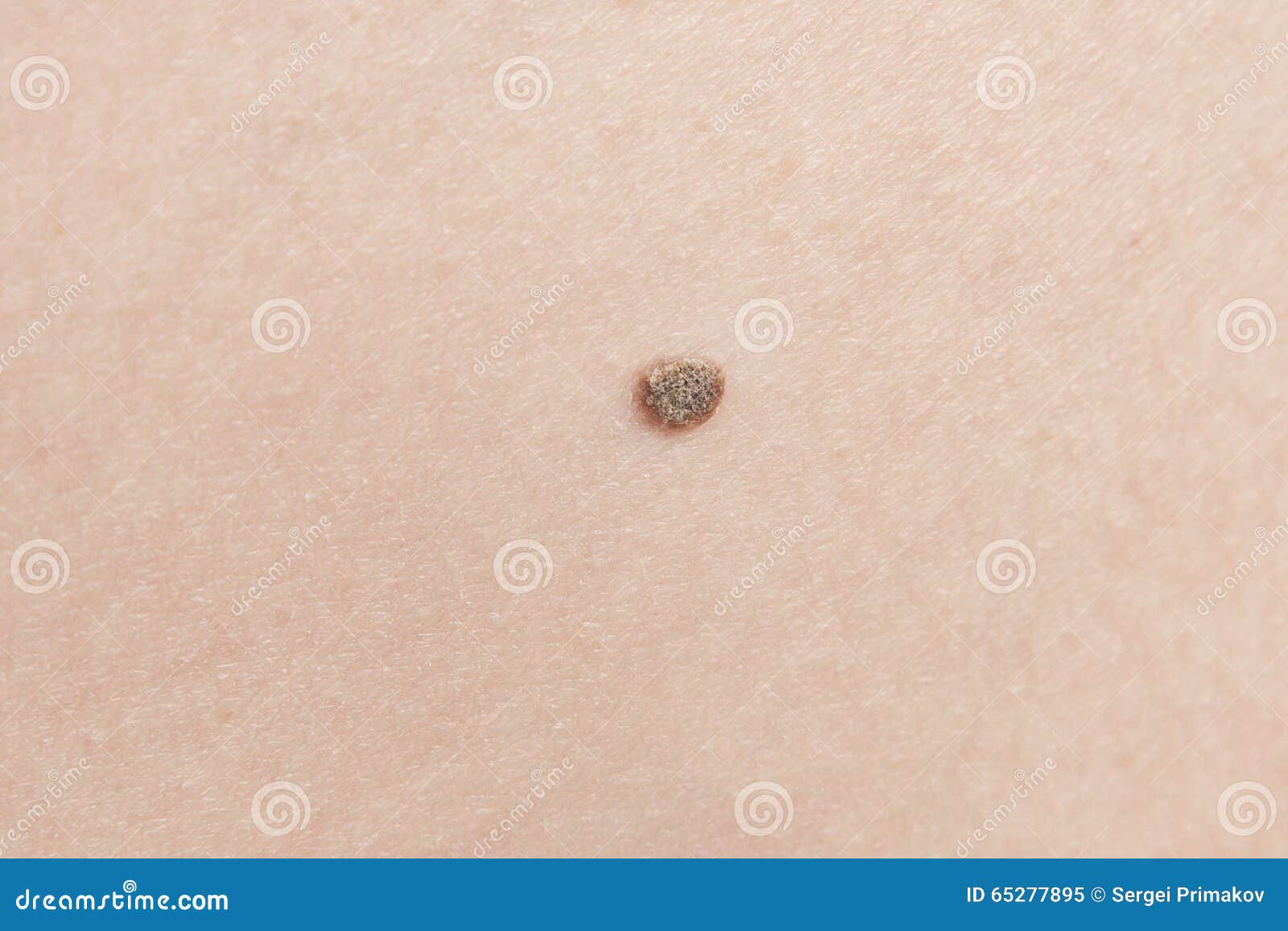 Keratinizing Squamous Cell Carcinoma Of The Skin Stock Photo ...