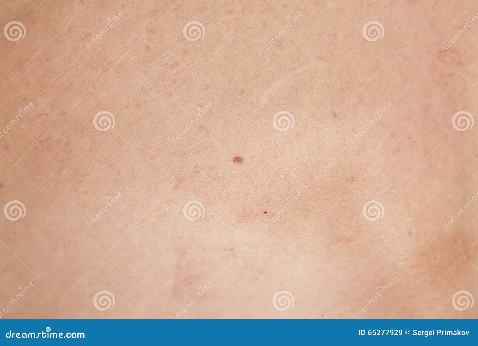 Keratinizing Squamous Cell Carcinoma of the Skin Stock Image - Image of ...