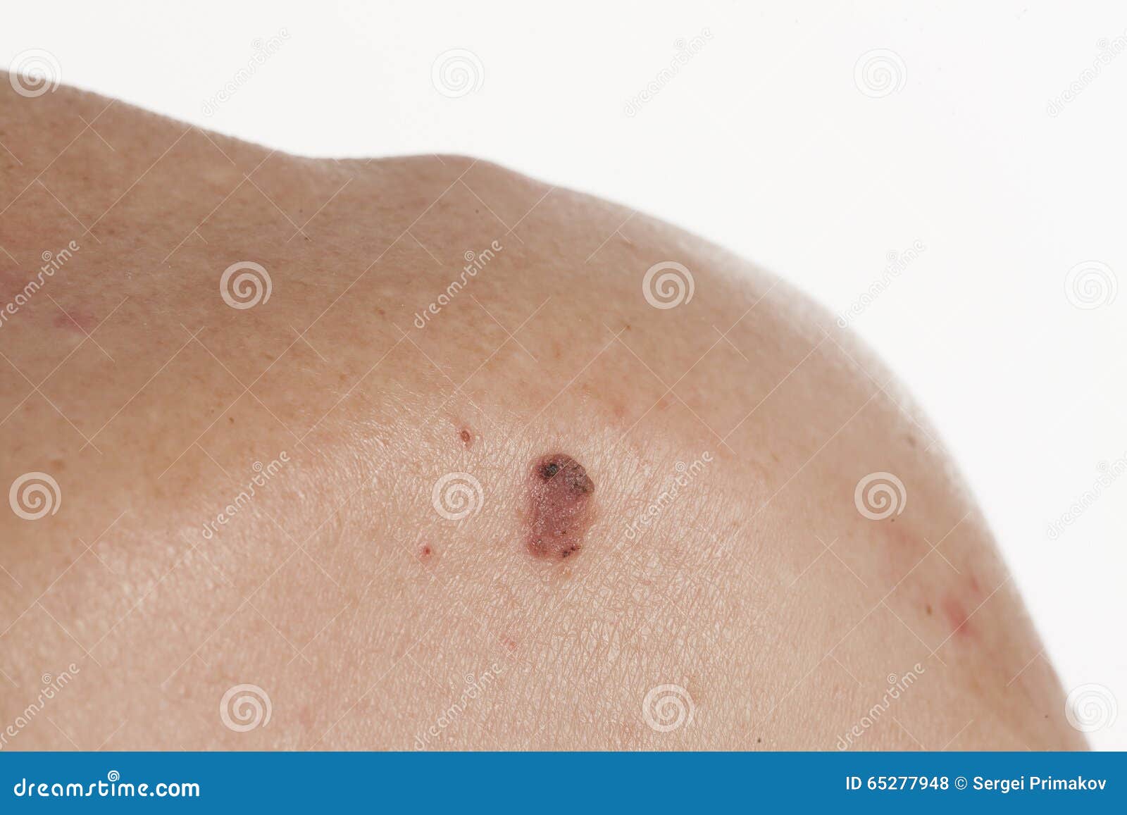 Keratinizing Squamous Cell Carcinoma of the Skin Stock Photo - Image of ...