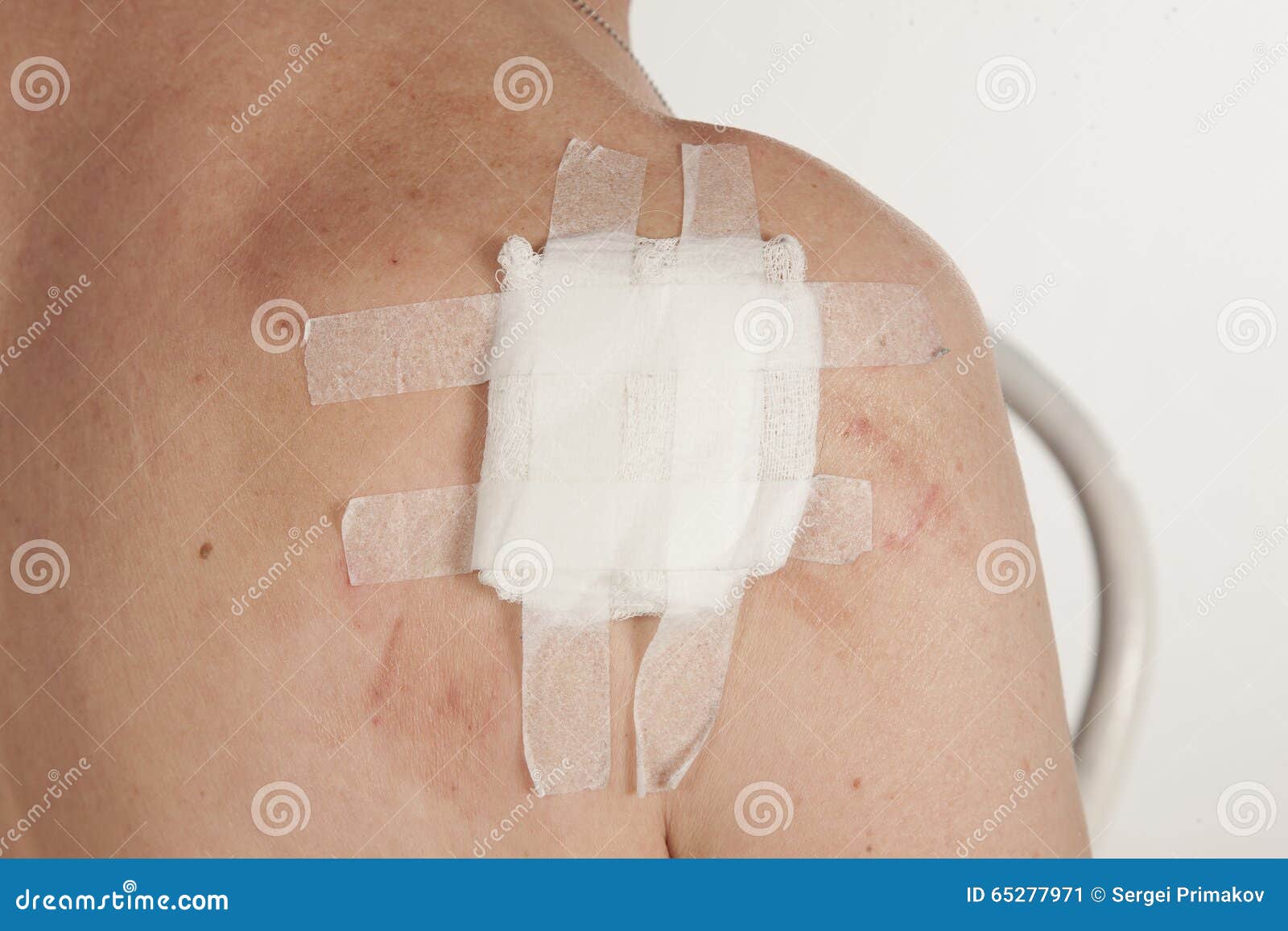 Keratinizing Squamous Cell Carcinoma of the Skin Stock Image - Image of ...