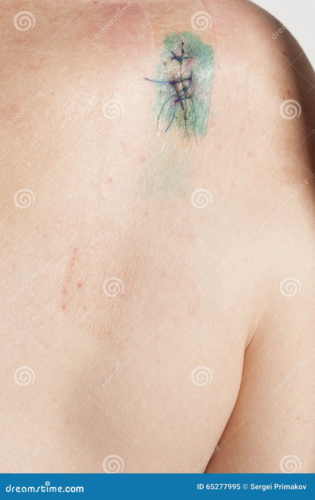 Keratinizing Squamous Cell Carcinoma of the Skin Stock Image - Image of ...
