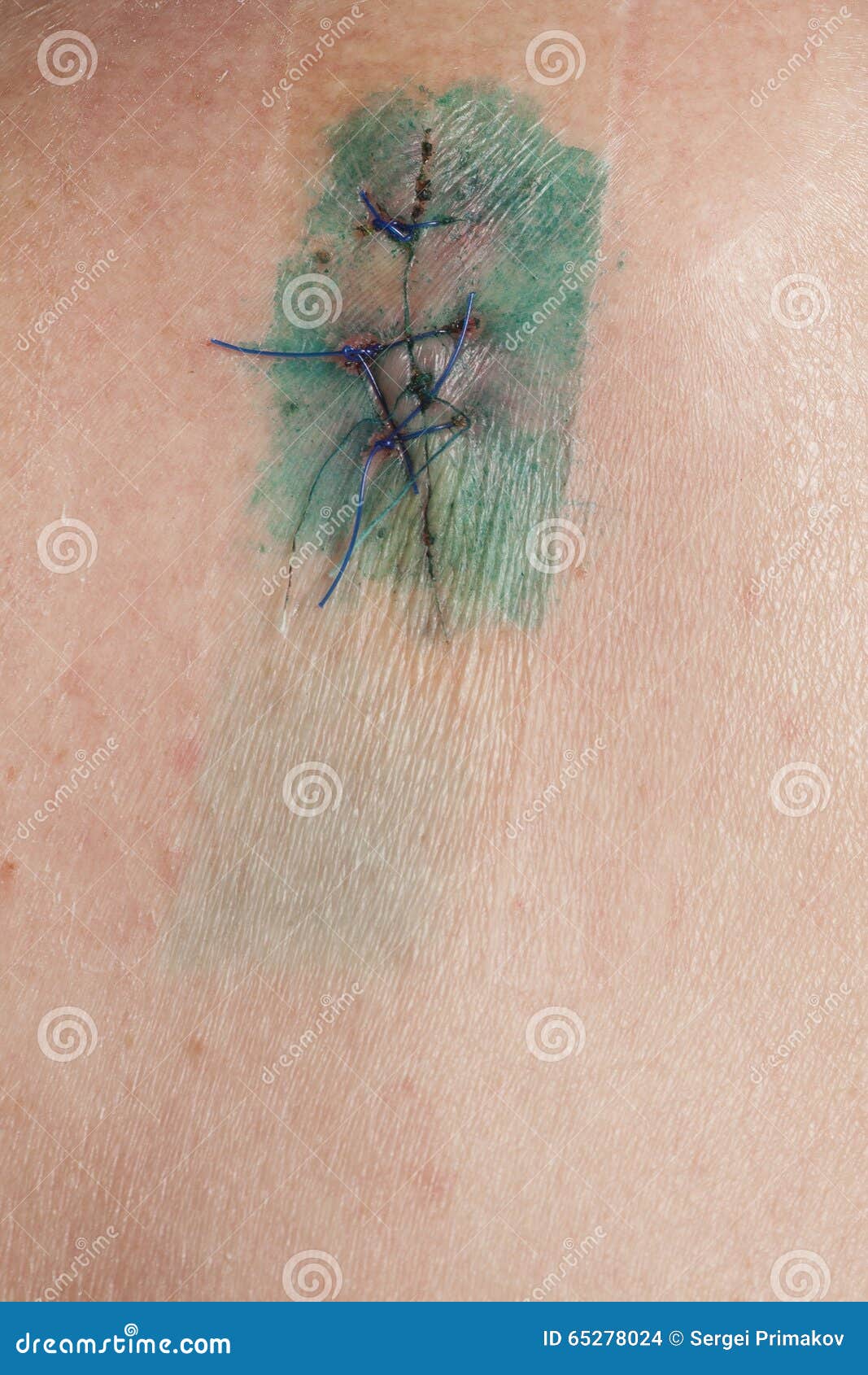 Keratinizing Squamous Cell Carcinoma of the Skin Stock Photo - Image of ...