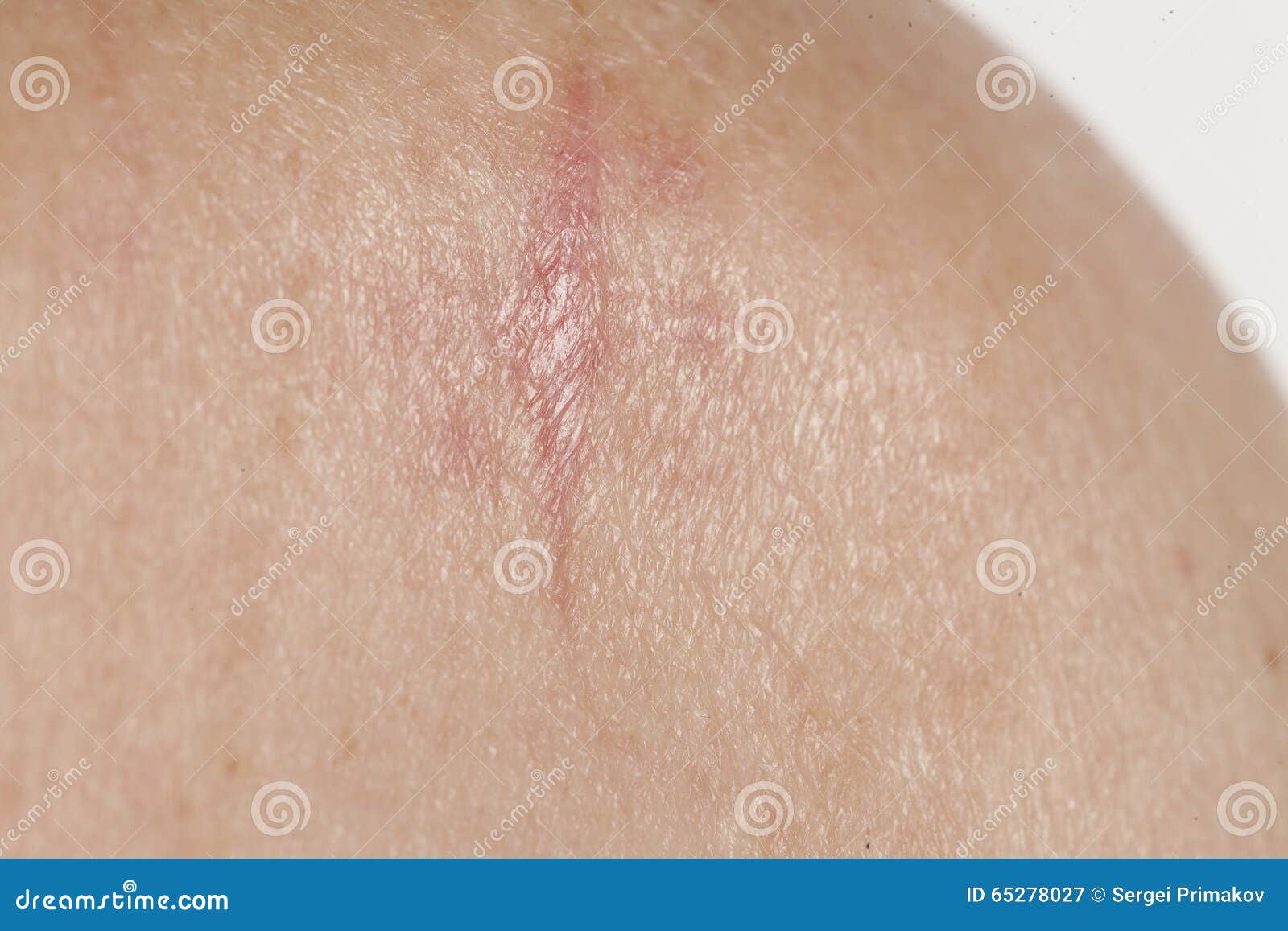 Keratinizing Squamous Cell Carcinoma of the Skin Stock Image - Image of ...