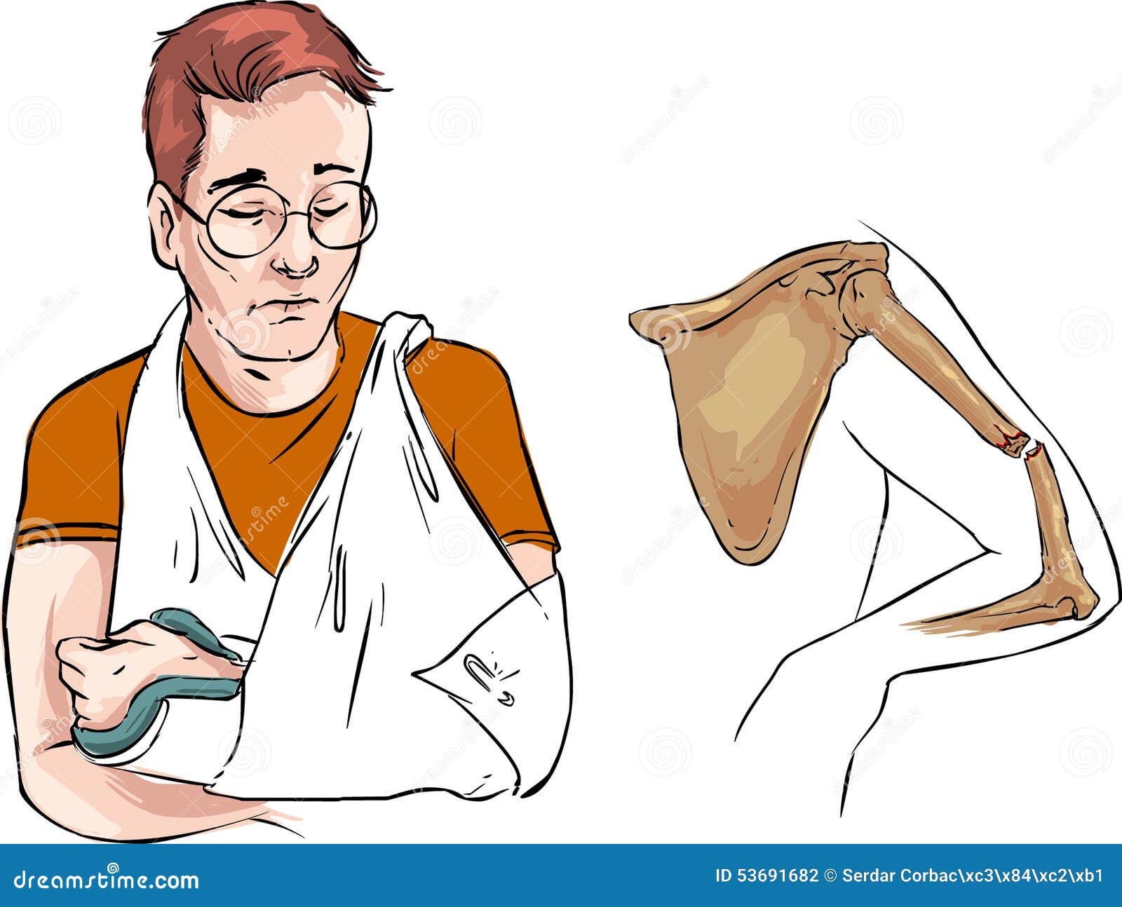 Kerl mit einem Armbruch vektor abbildung. Illustration von leid - 53691682