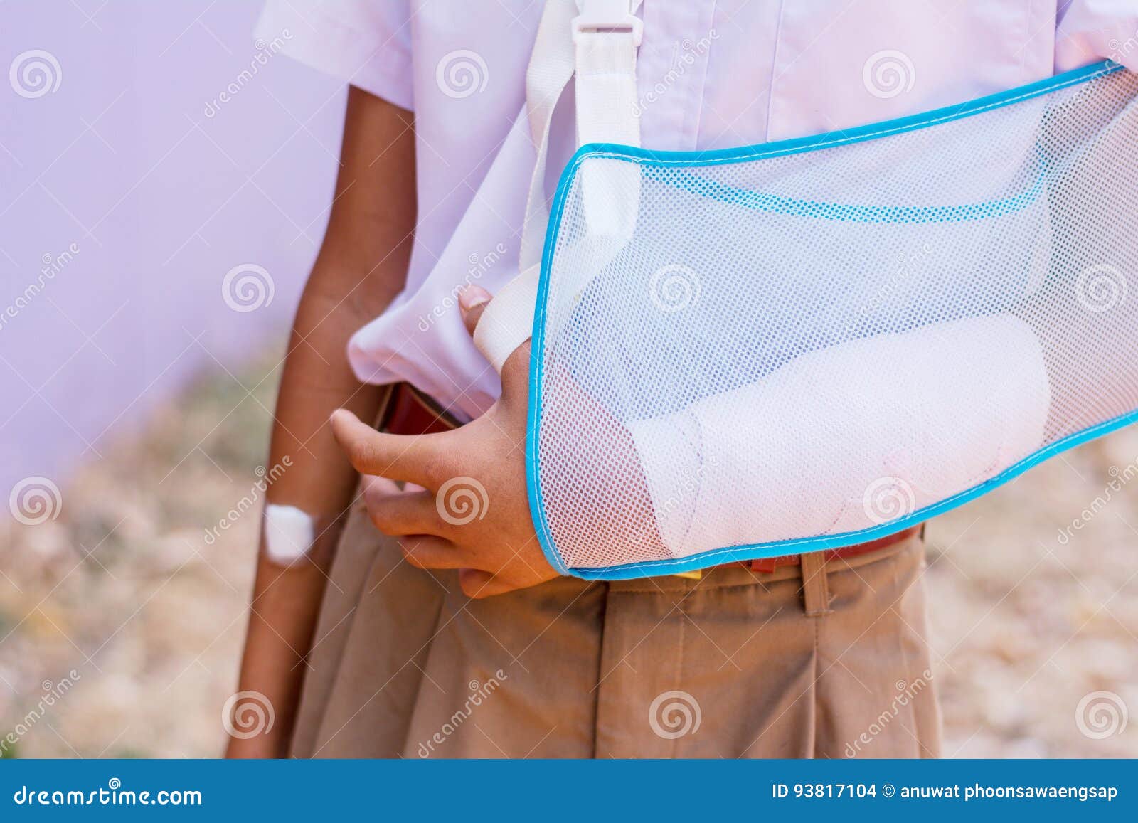 Kid with Broken Arm To Cast. Stock Photo - Image of childhood ...