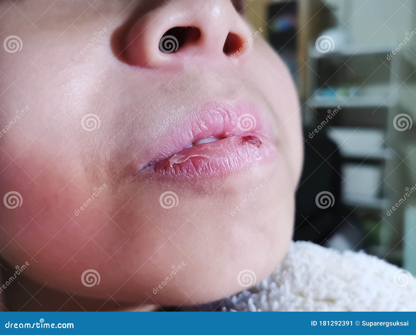 Kid`s Dry Bruised Lip with Selective Focus Stock Image - Image of bite ...