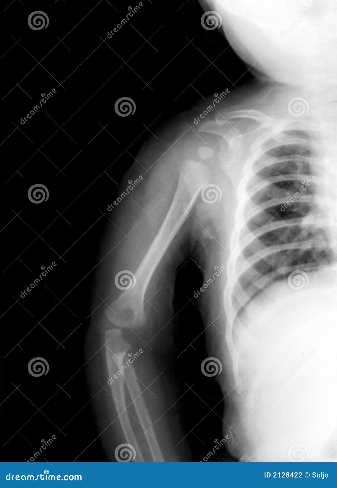 Kid shoulder stock photo. Image of hospital, disease, body - 2128422