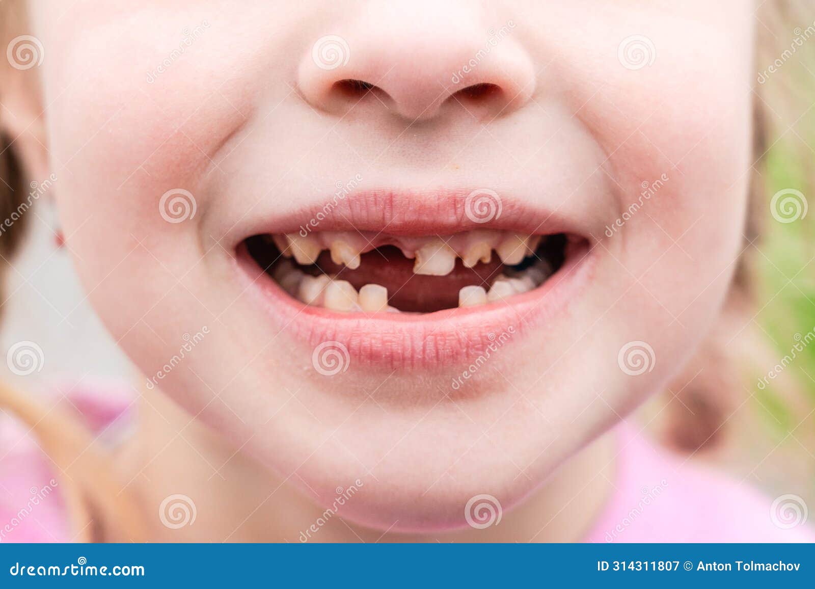 Kid Shows Off First Missing Tooth. Children without One Tooth Smiles ...