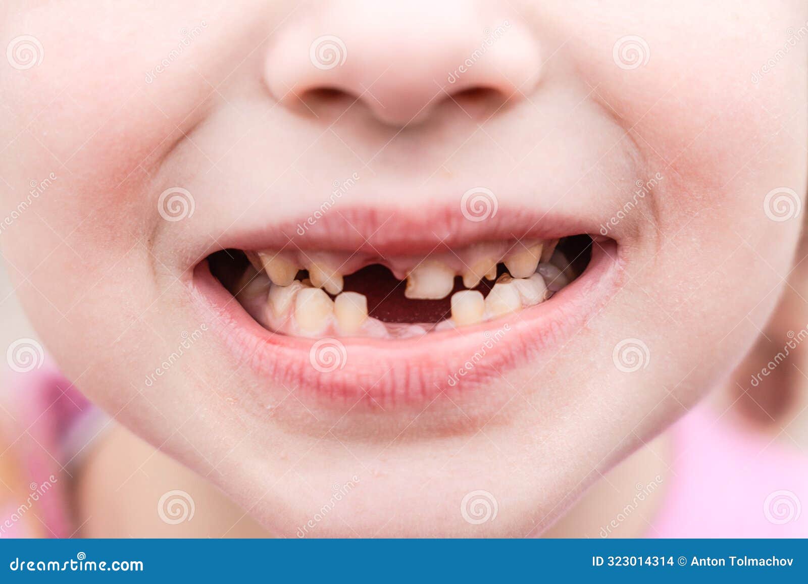 Kid Shows Off First Missing Tooth. Children without One Tooth Smiles ...