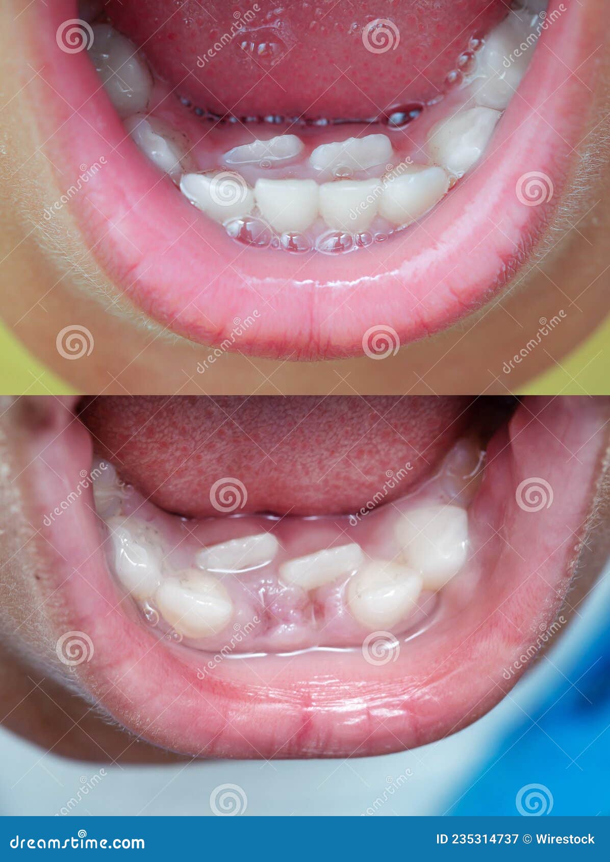 Kid with Two Row Teeth before and after Removal Stock Image - Image of ...