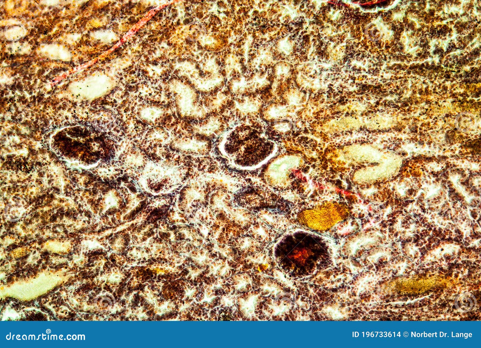 Kidney Bleeding Diseased Tissue Stock Photo - Image of kidney, science ...