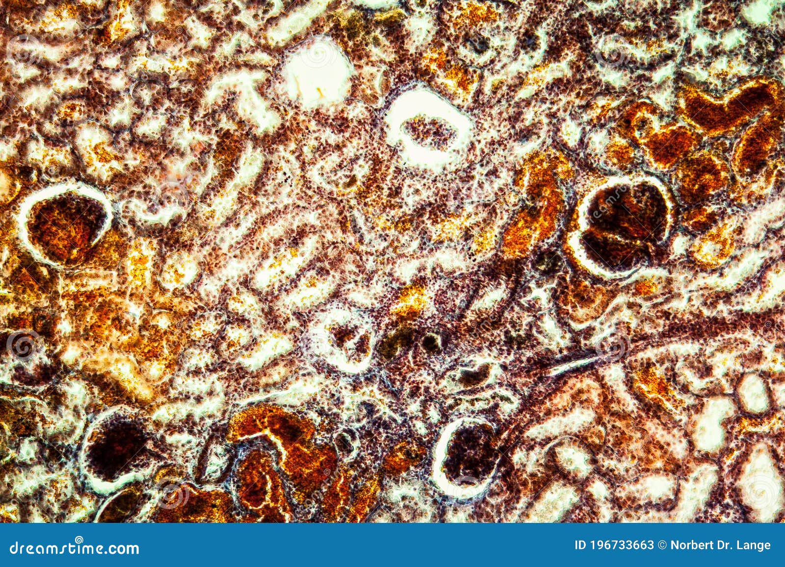 Kidney Bleeding Diseased Tissue Stock Image - Image of medicine ...