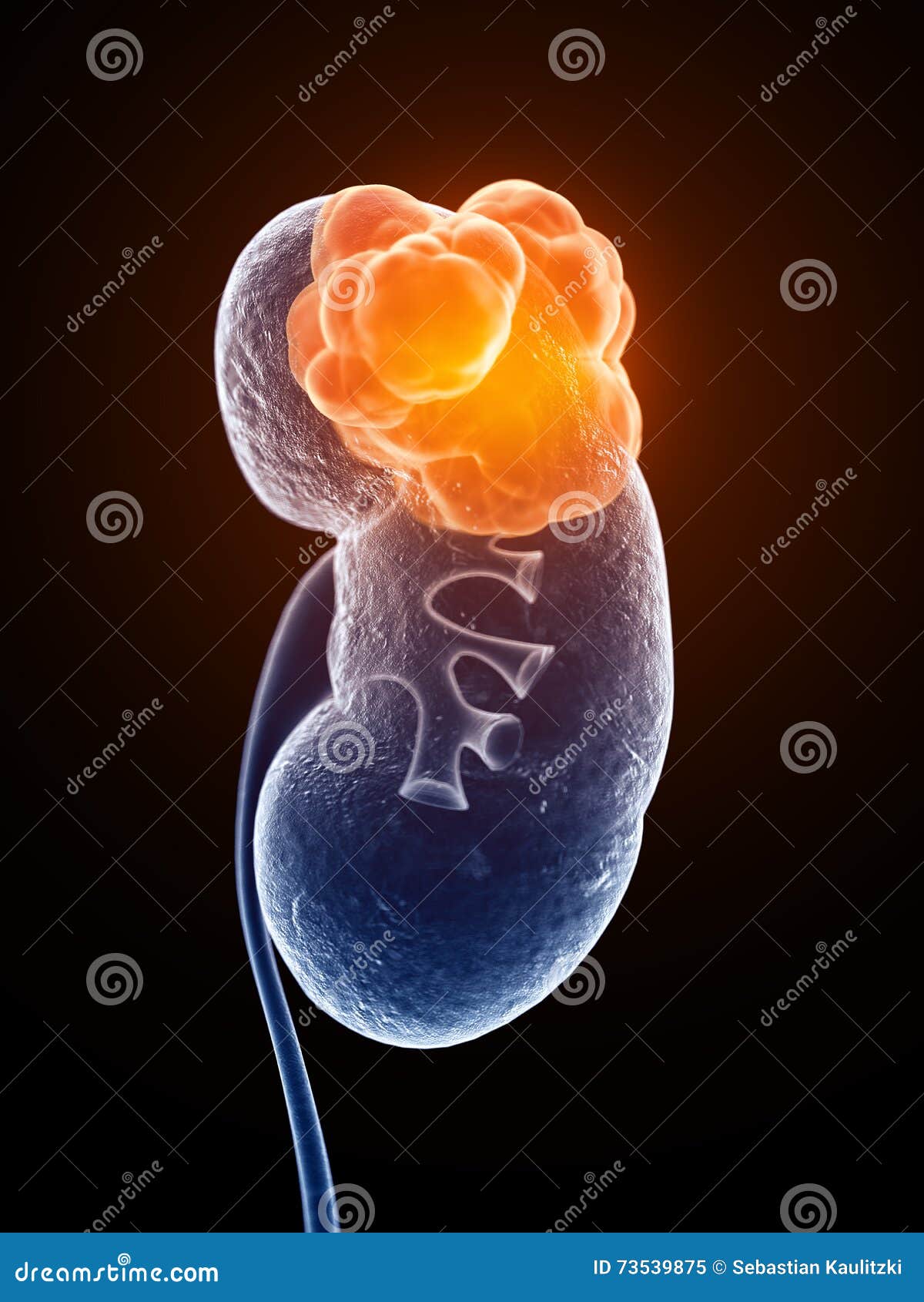 Kidney cancer stock illustration. Illustration of rendering - 73539875