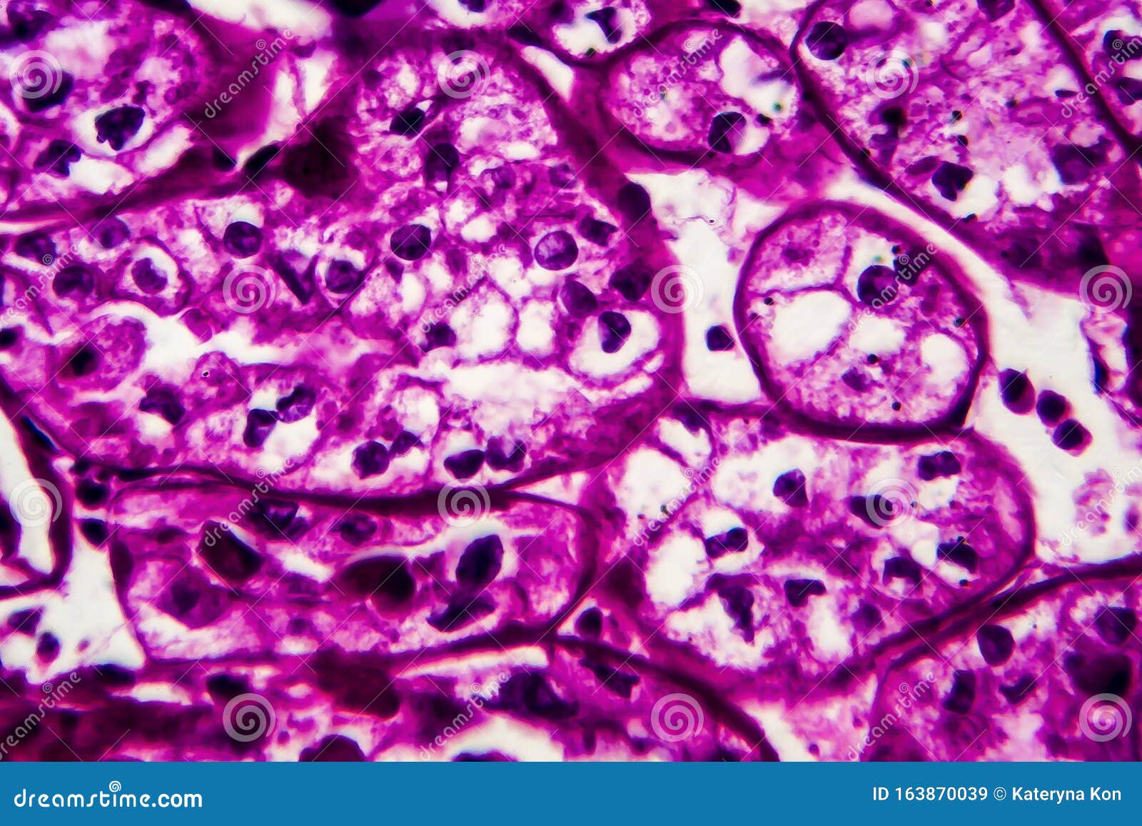 Kidney Cancer, Light Micrograph Stock Image - Image of medicine ...