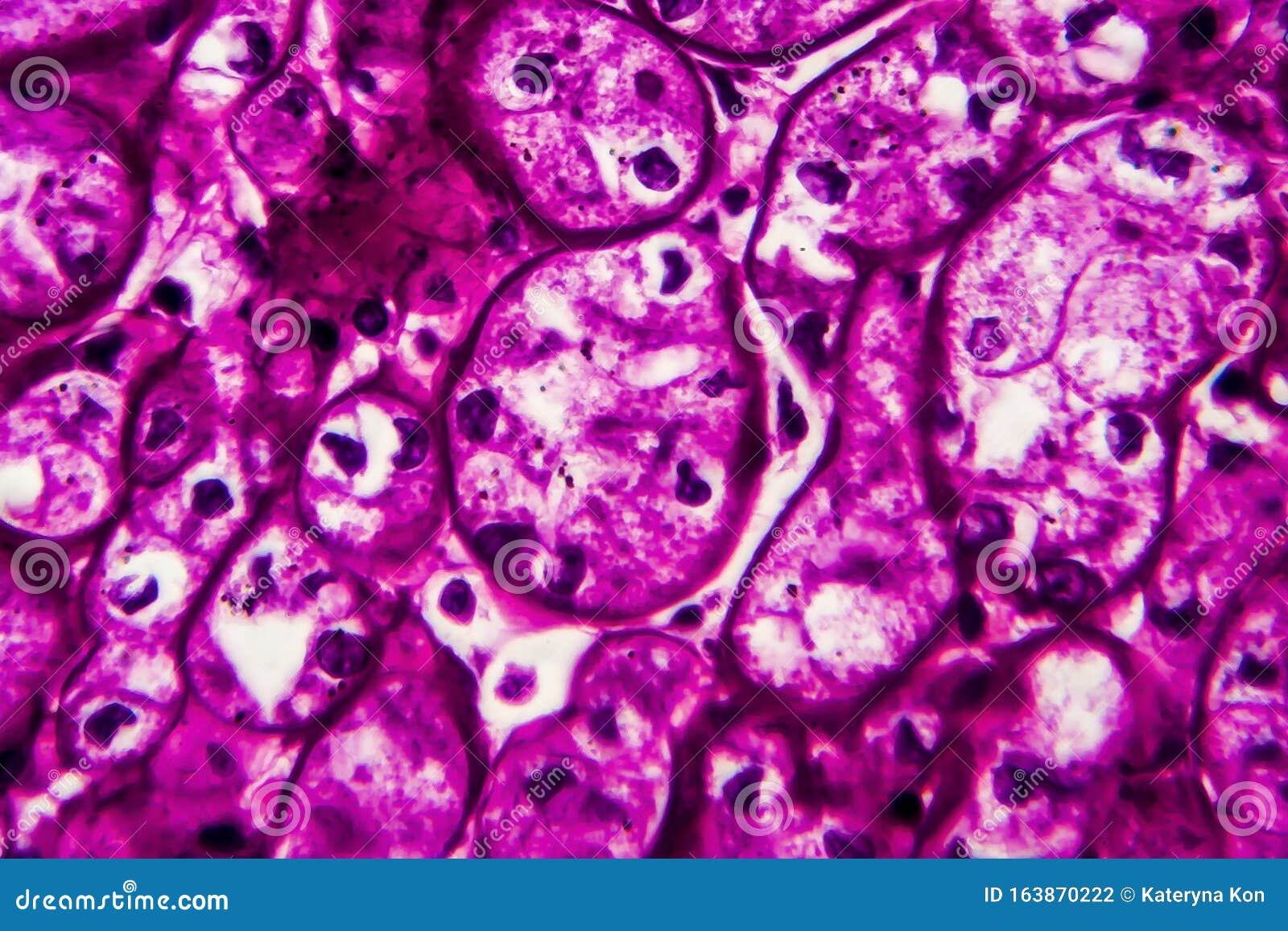 Kidney Cancer, Light Micrograph Stock Photo - Image of histopathology ...