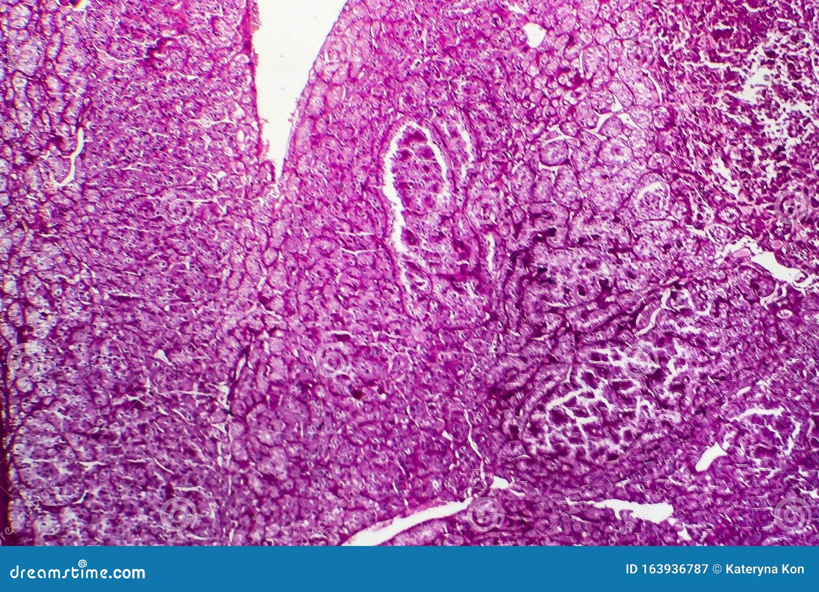 Kidney Cancer, Light Micrograph Stock Image - Image of microscopic ...