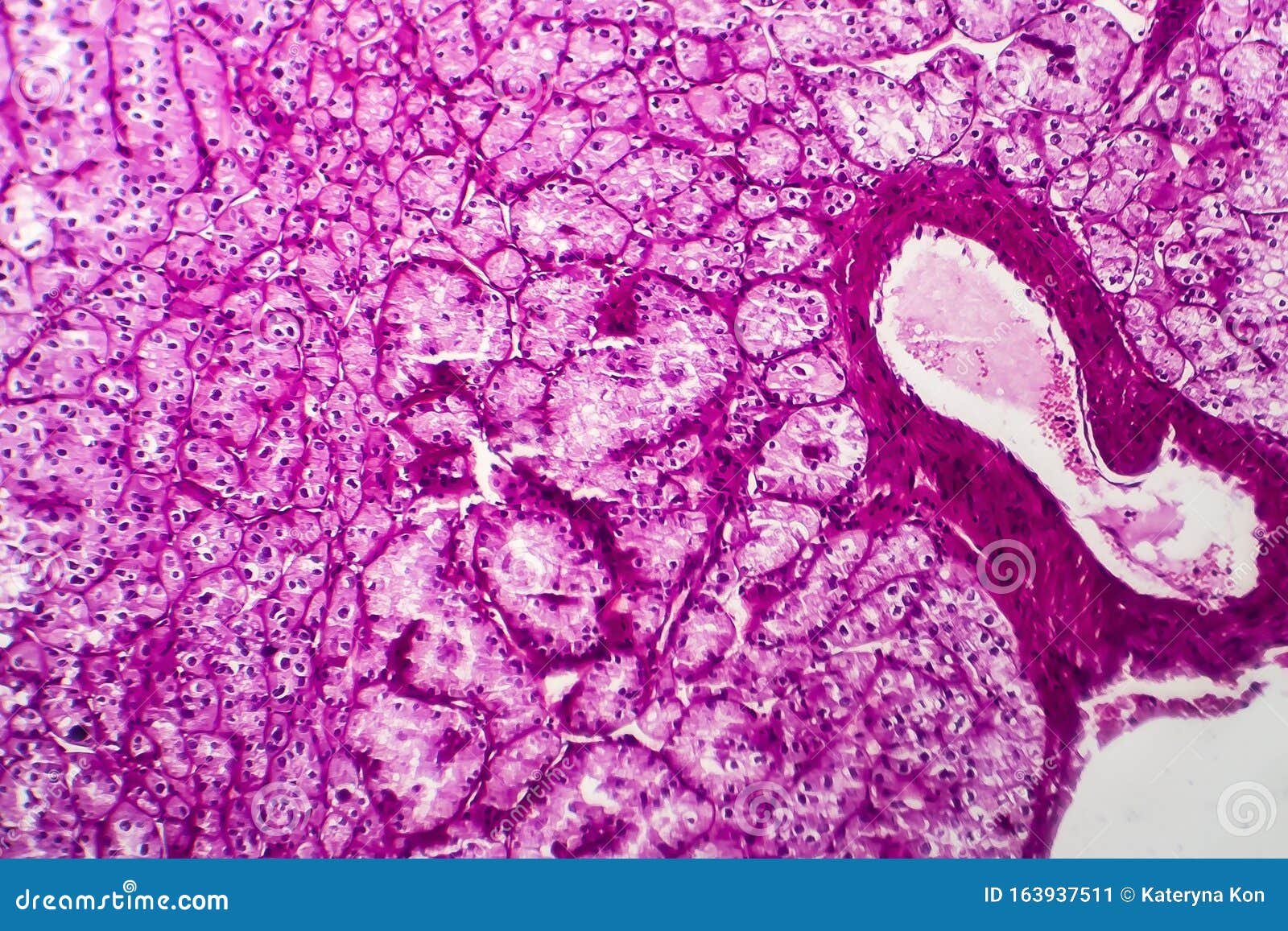 Kidney Cancer, Light Micrograph Stock Image - Image of neoplasm ...