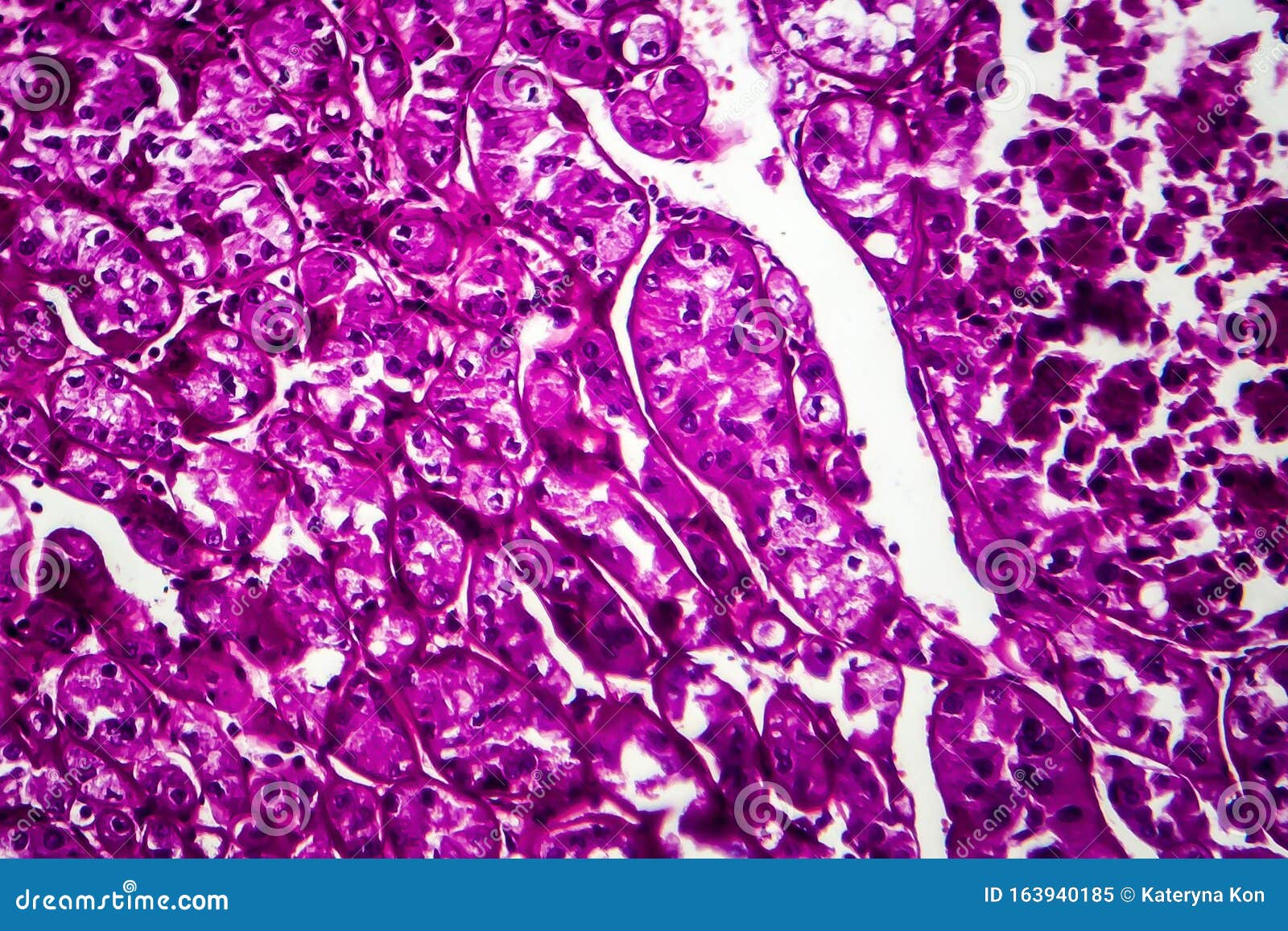 Kidney Cancer, Light Micrograph Stock Image - Image of malignant ...