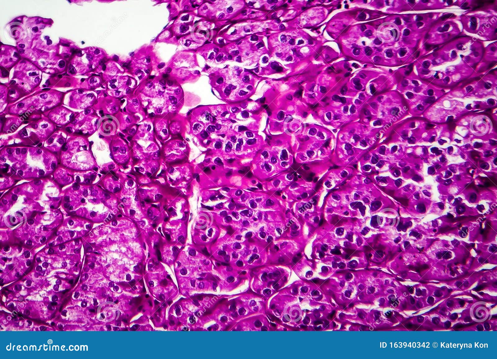 Kidney Cancer, Light Micrograph Stock Photo - Image of malignant ...