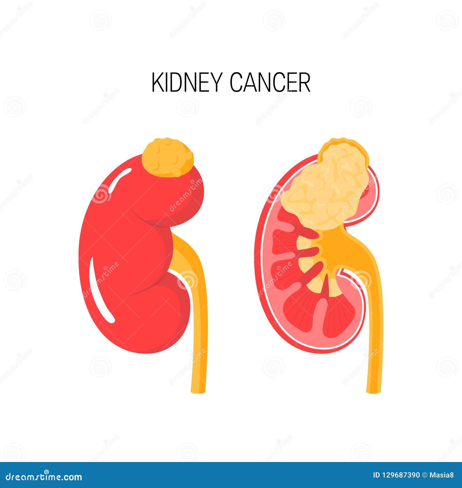 Urothelial Carcinoma Outline Poster. Urinary Bladder Cancer Banner ...