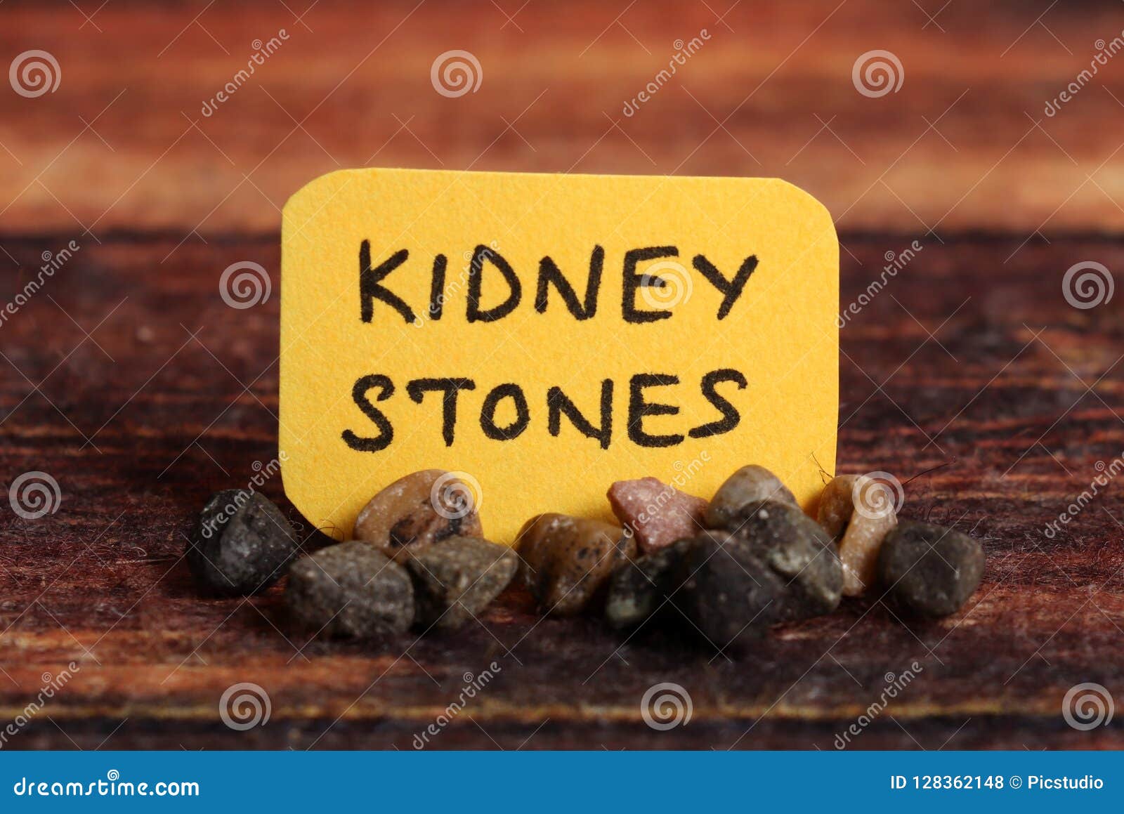 Kidney stones stock photo. Image of stones, written - 128362148